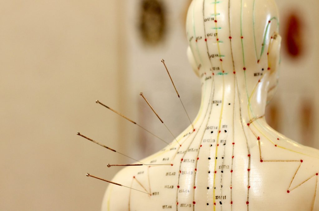 Acupuncture – Acuupain